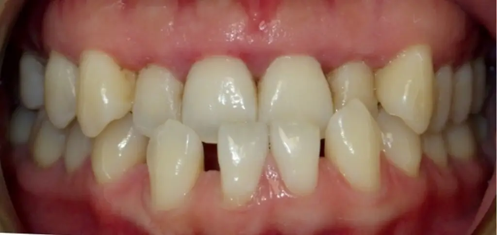 Crossbite Treatment Options: Braces, Invisalign, and More