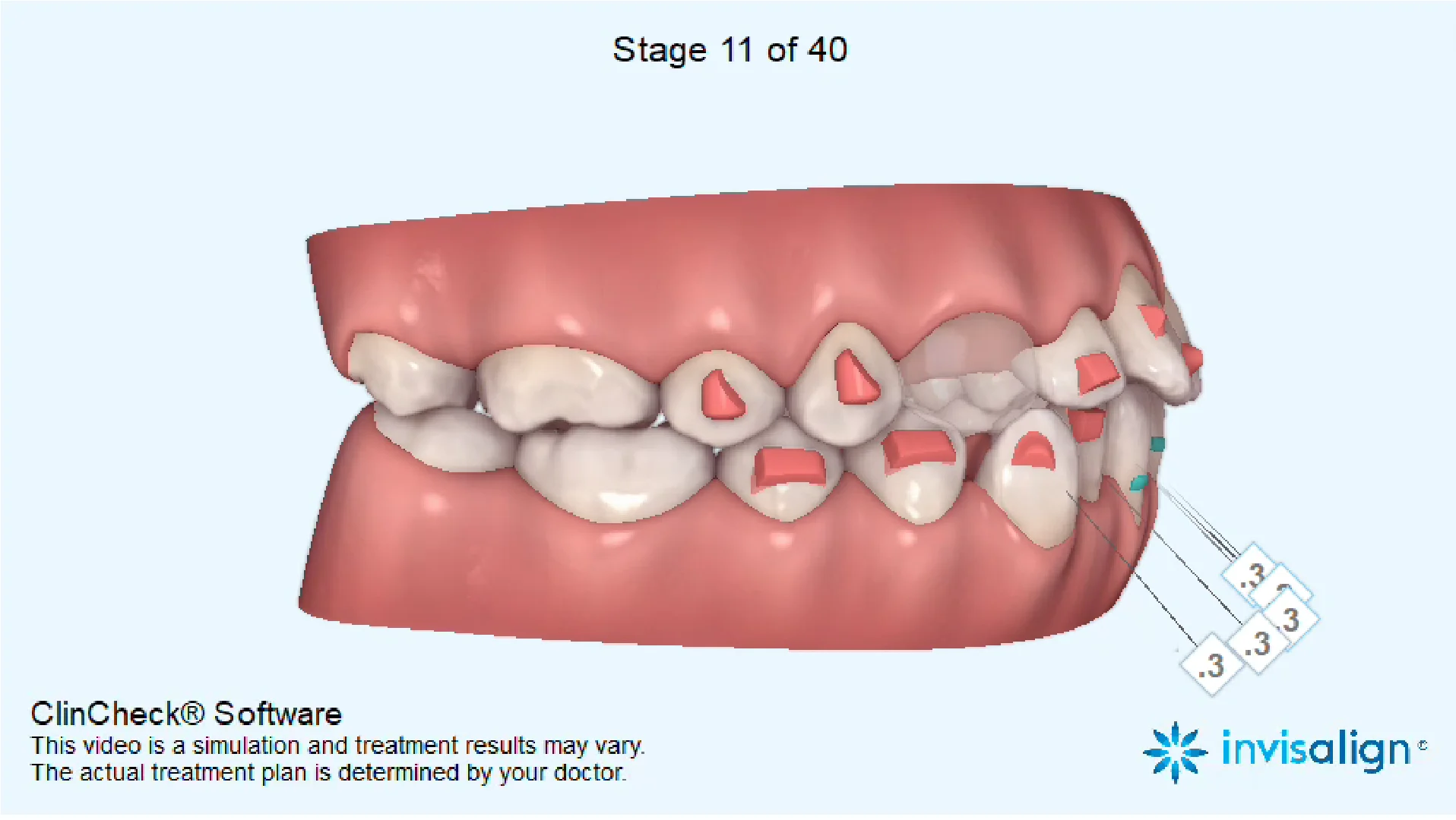 Impacted Front Teeth