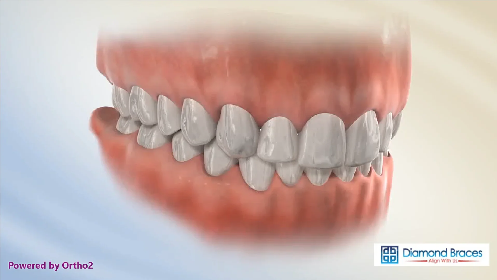 Impacted Front Teeth