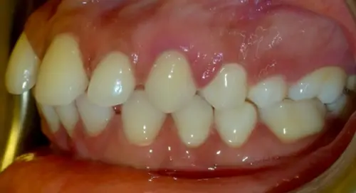 Everything You Need to Know About Spaces/Gaps Between Teeth