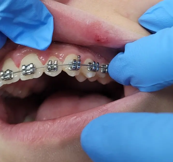 Incomodidad Dental: Manejo del Dolor con Frenillos