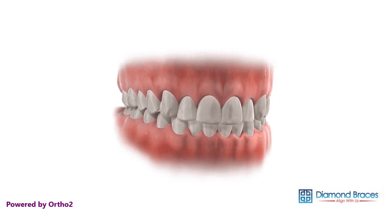 Tie Dye Retainer Designs